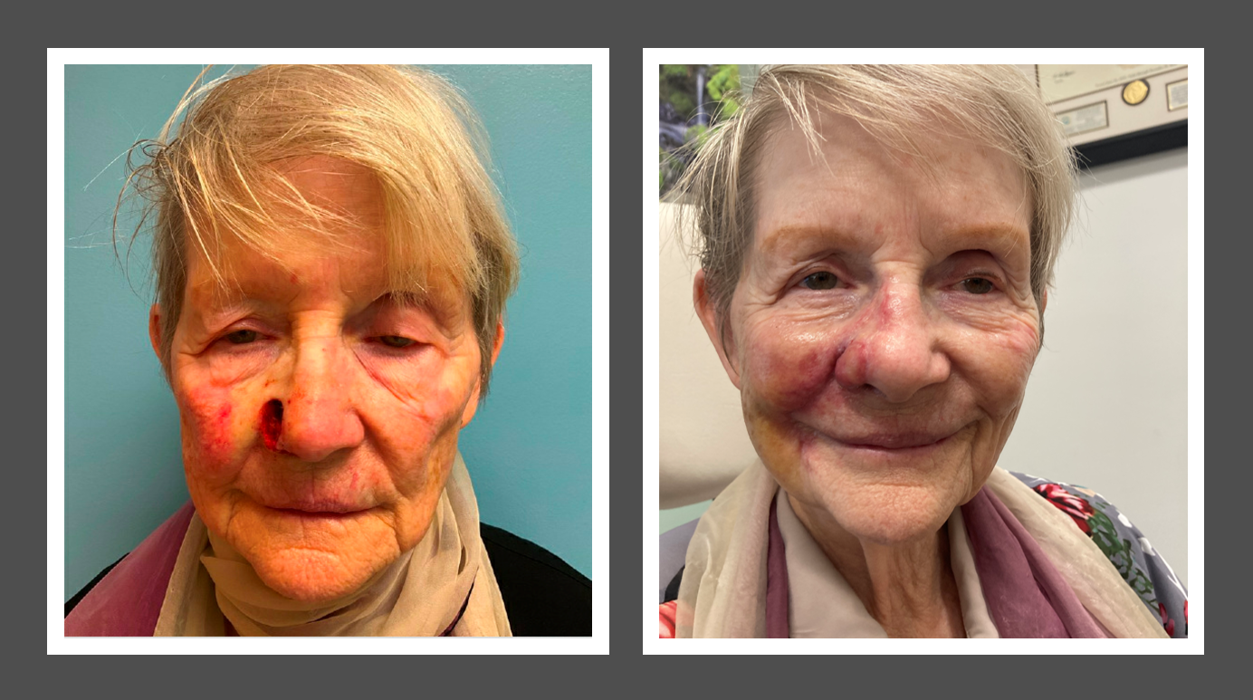 Mohs Nasal Reconstruction | Otolaryngology | Head and Neck Surgery