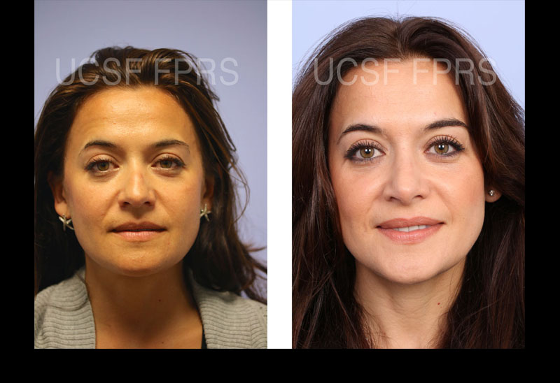 Rhinoplasty: Before and After Gallery | Otolaryngology | Head and Neck ...
