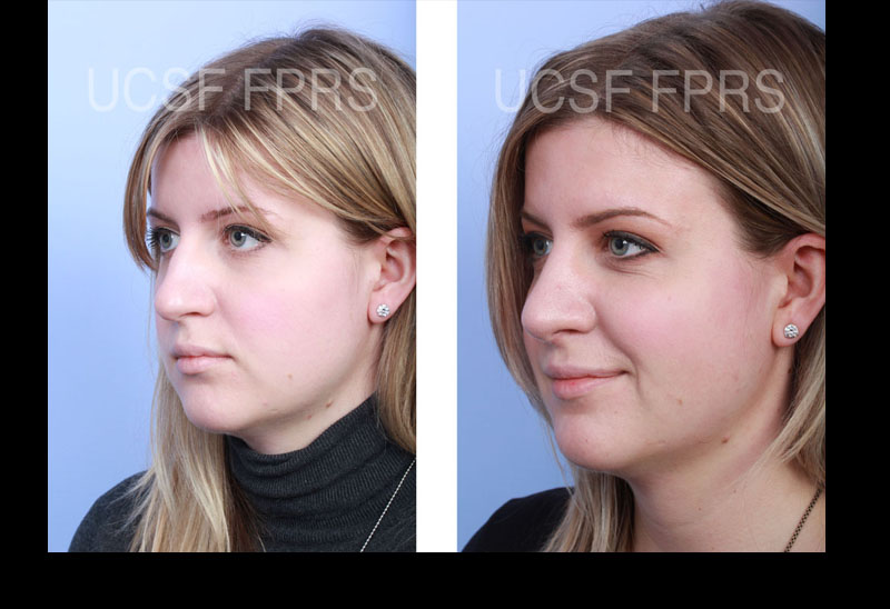 Rhinoplasty: Before and After Gallery | Otolaryngology | Head and Neck ...