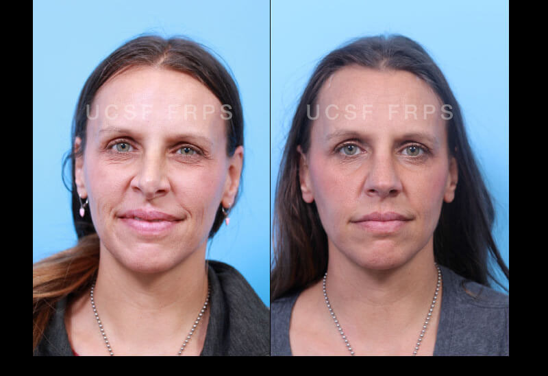 Revision Rhinoplasty | Otolaryngology | Head and Neck Surgery