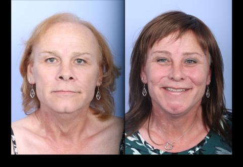 Facial Feminization Surgery (FFS) | Otolaryngology | Head and Neck Surgery
