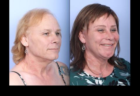 Facial Feminization Surgery (FFS) | Otolaryngology | Head and Neck Surgery