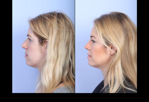 Rhinoplasty | Otolaryngology | Head and Neck Surgery