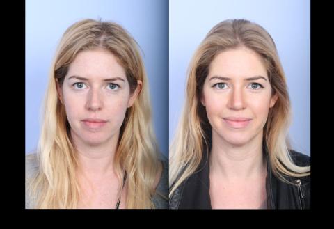 Rhinoplasty | Otolaryngology | Head and Neck Surgery